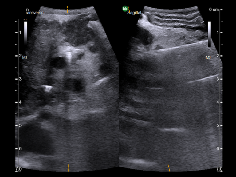 Intraoperative Ultrasound for General Surgery | BK Medical