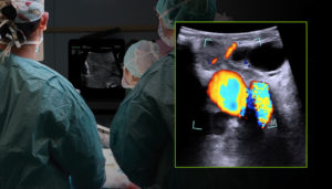 Intraoperative Ultrasound for General Surgery and HPB | BK Medical